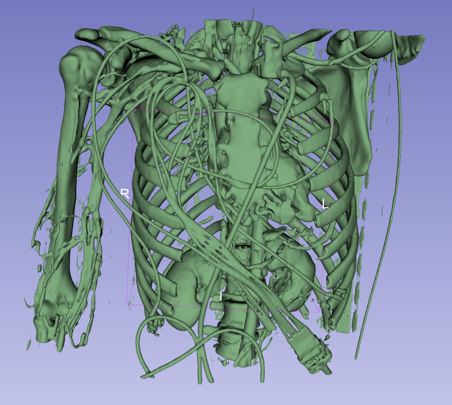 Segmentation tools : The Impact of Slicer 3D on Modern Medicine
