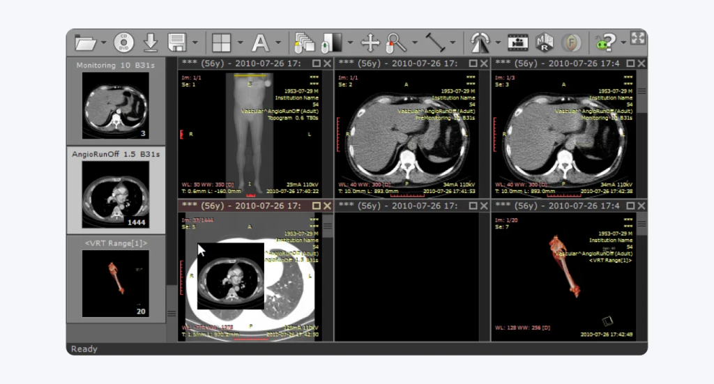 DICOM to STL: Medical Image Segmentation & Printing