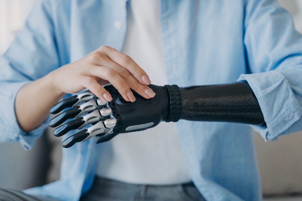 3D Printed Arm Prosthetic: Advanced Bionic Limbs